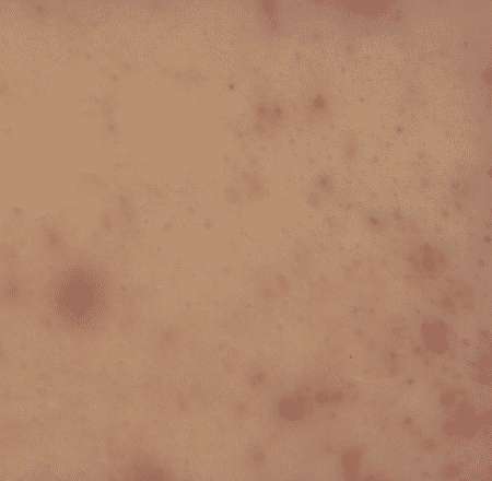 Oily skin and hyperseborrhea - Cosmetic efficacy studies, in vitro tests