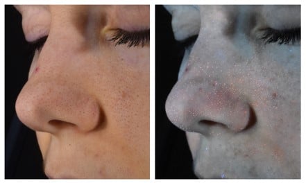 Oily skin and hyperseborrhea - Cosmetic efficacy studies, in vitro tests