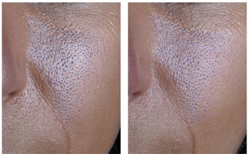 Oily skin and hyperseborrhea - Cosmetic efficacy studies, in vitro tests