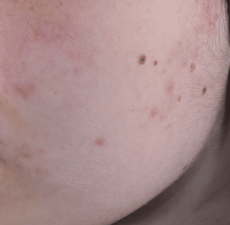 Oily skin and hyperseborrhea - Cosmetic efficacy studies, in vitro tests