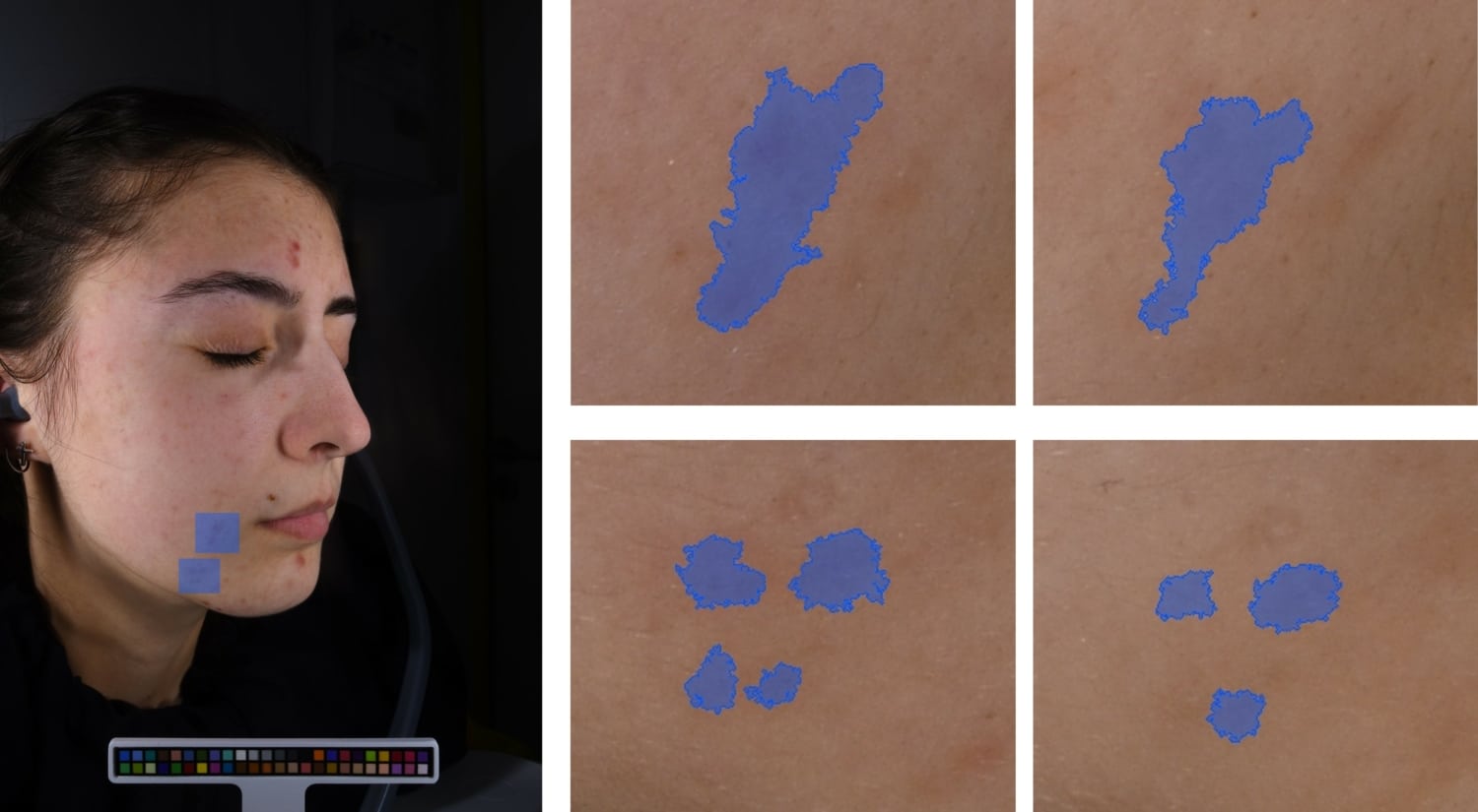 Oily skin and hyperseborrhea - Cosmetic efficacy studies, in vitro tests