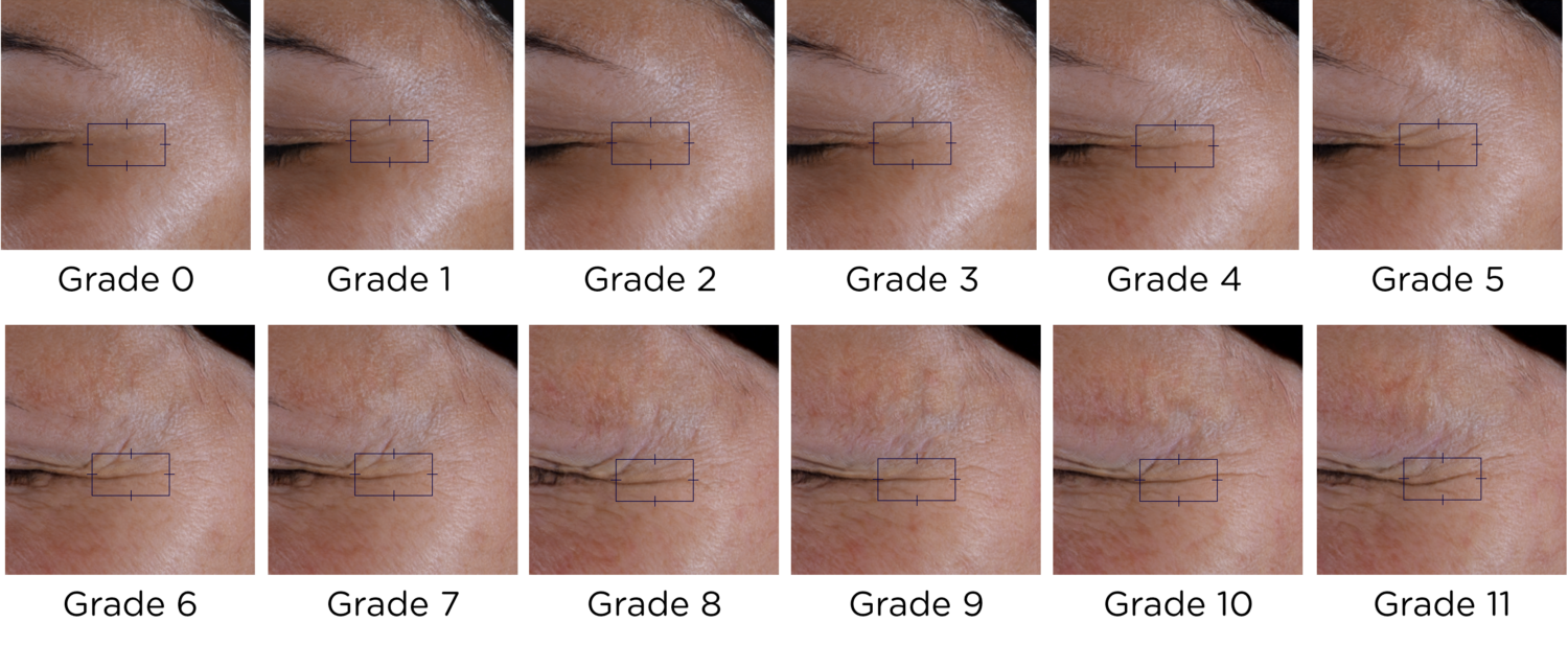 Digital imaging analysis enhances clinical evaluation of skin aging