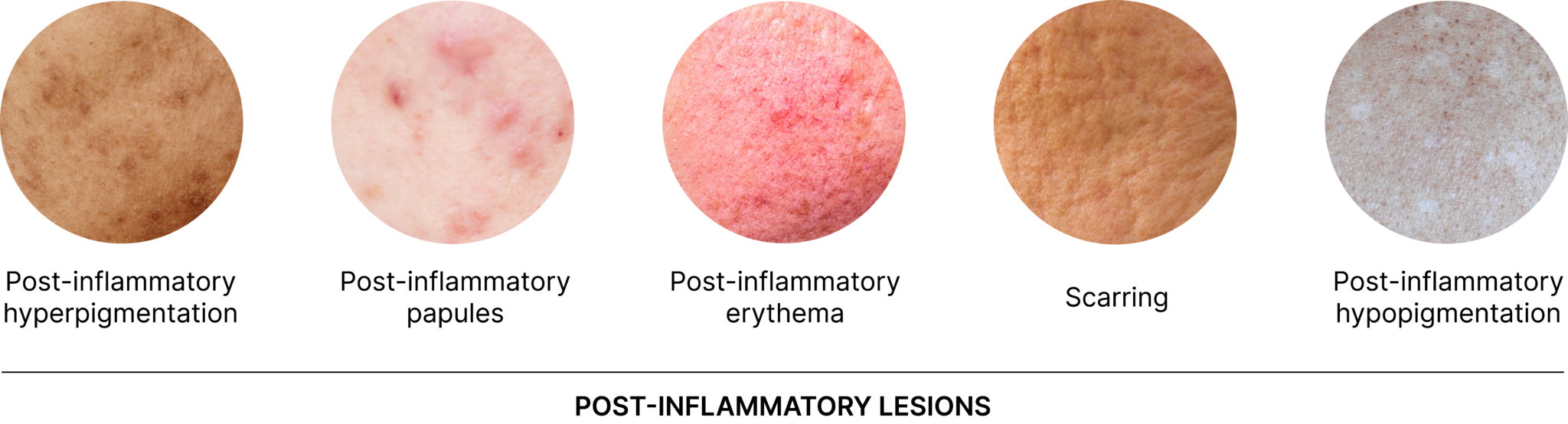 Understanding and Managing Post-Inflammatory Acne Lesions - QIMA Life ...