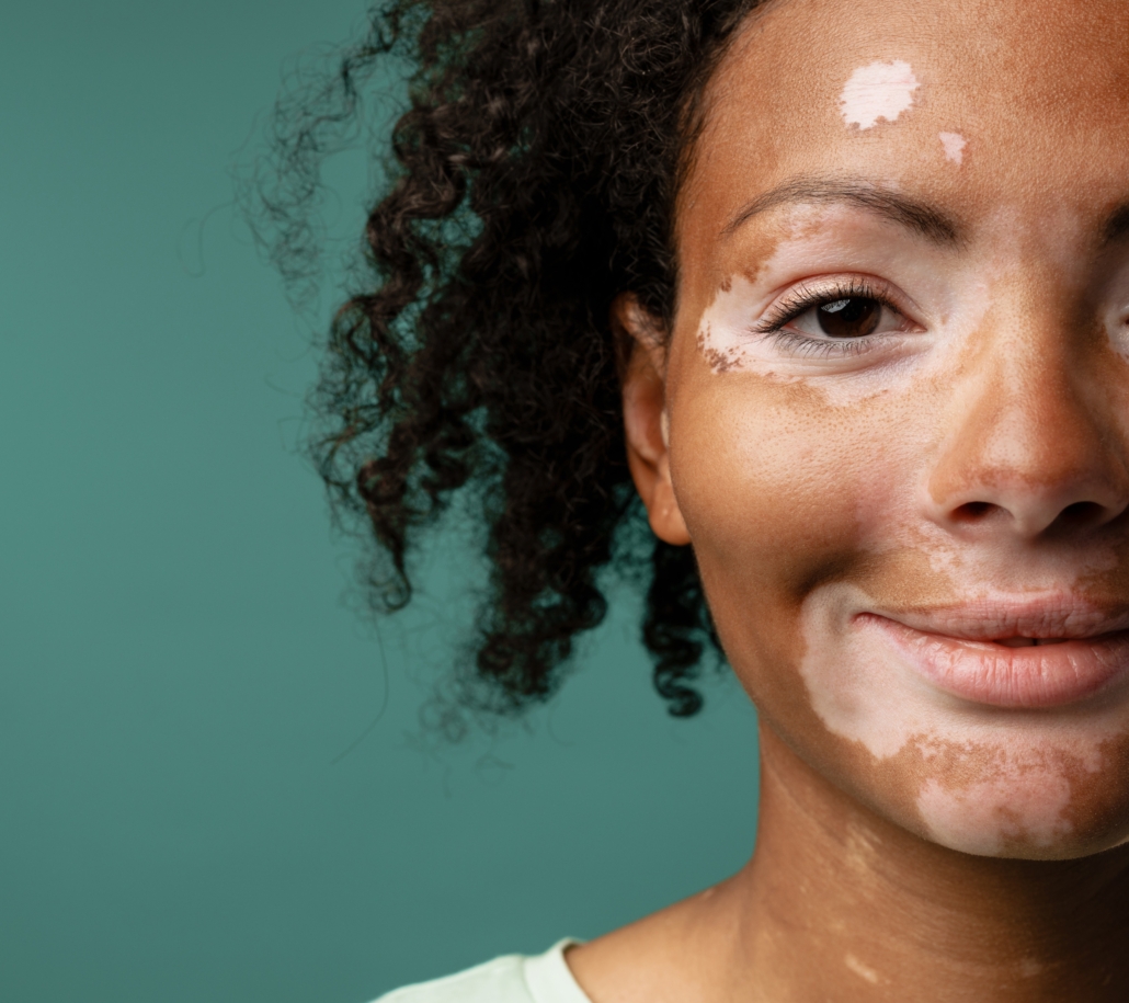 Vitiligo-induced ex vivo model | QIMA Life Sciences