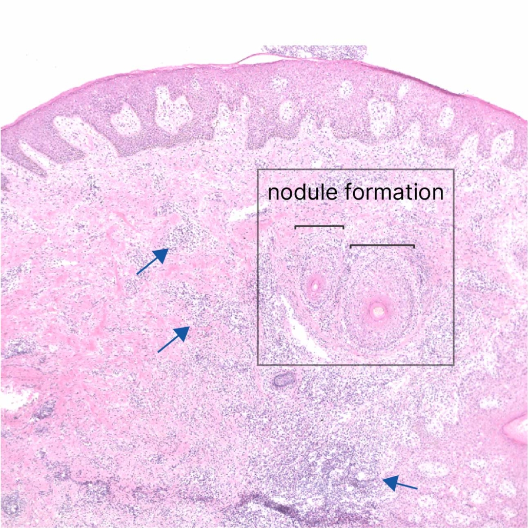 Hidradenitis Suppurativa | Preclinical Dermatology Research