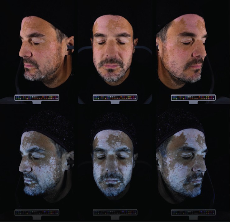 Vitil-IA®: Revolutionary AI Algorithm for Vitiligo Assessment