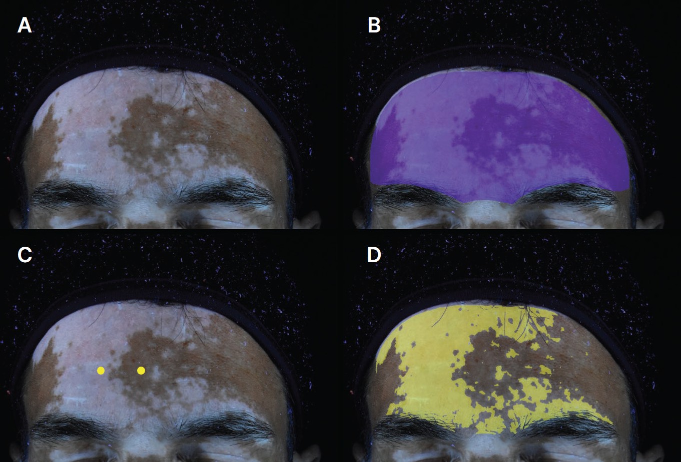 Vitil-IA®: Revolutionary AI Algorithm for Vitiligo Assessment
