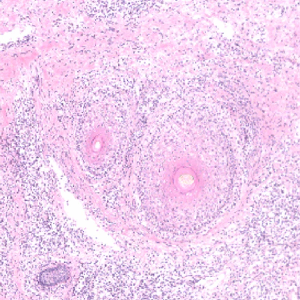 Hidradenitis Suppurativa | Preclinical Dermatology Research